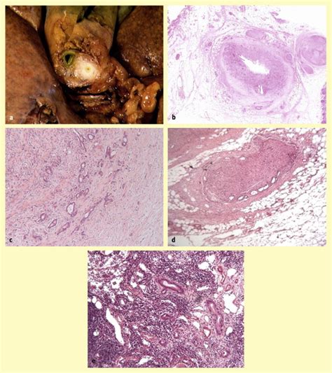 Cholangiocarcinoma Pathology Outlines