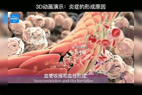3d动画演示：炎症的形成原因