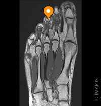 Digits Of Foot E Anatomy Imaios