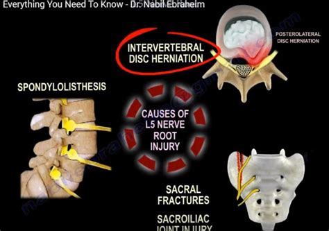 L5 Nerve Root Clinical Exam And Pathologies —