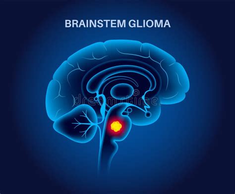 Brainstem Glioma Cancer Stock Illustration Illustration Of Tumor