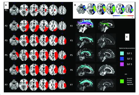 Description Of Lesions In Patients A Reconstruction Of The Brain