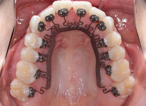 Red Braces For Teeth