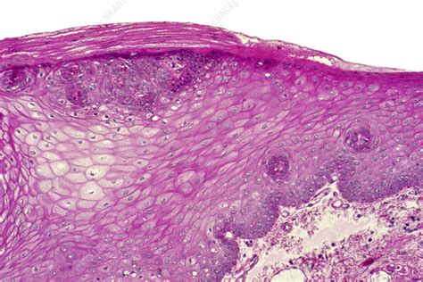 Leukoplakia Light Micrograph Stock Image C0614708 Science Photo
