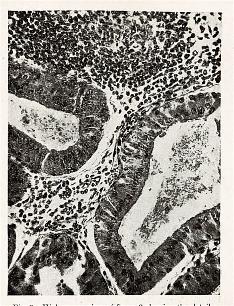 Figure 3 From Lymphadenoma Of The Salivary Glands Semantic Scholar