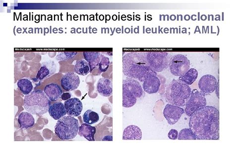 Malignant Hematopoiesis 1 Myeloproliferative Disorders Emanuel Neas