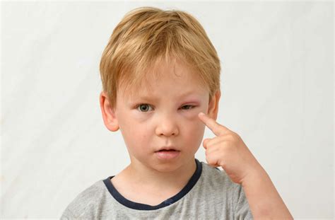 How To Help Swollen Eyelids Toronto