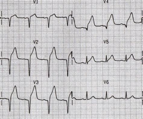 Q Wave • Litfl • Ecg Library Basics
