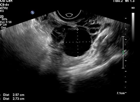 Gynaecologische Echo In Eindhoven Verloskunde