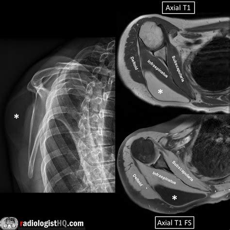 Retroscapular Lipoma On Radiologist Headquarters Facebook