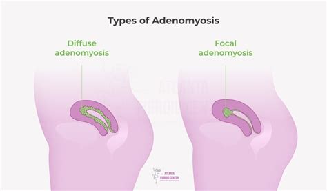Adenomyosis Enlarged Uterus Causes Diagnosis And Treatment