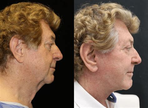 Neck Lift Platysmaplasty Case No 3