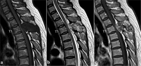 Spinal Enchondroma Pacs