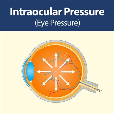 Ocular Pressure For Glaucoma At Lisa Bassett Blog
