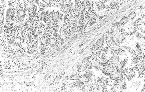 Cholangiocarcinoma Moderately Well Differentiated Area Showing