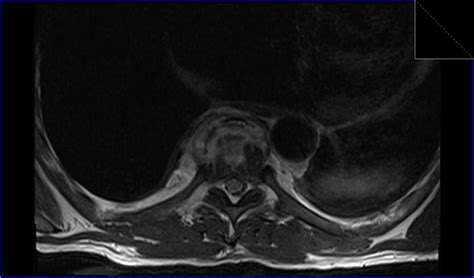 Discitis Mri Radiology Article On How To Report Spondylodiscitis