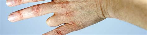 Finger Amputation Surgery Dallas Hand Surgeons Dr Azouzazouz Hand