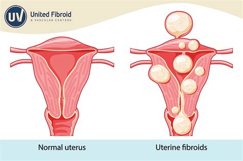 What Size Fibroids Should Be Removed United Fibroid And Vascular Centers
