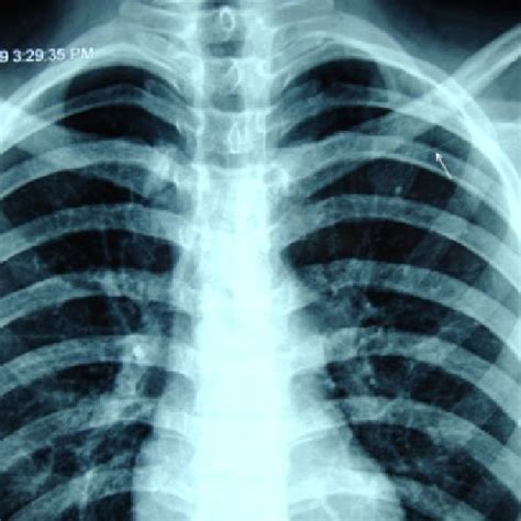 Cxr Showing Picc In Place Download Scientific Diagram