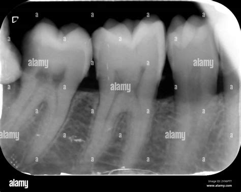 Periapical X Ray Of A Healthy Right Lower Premolar And The First And Second Molars A Periapical
