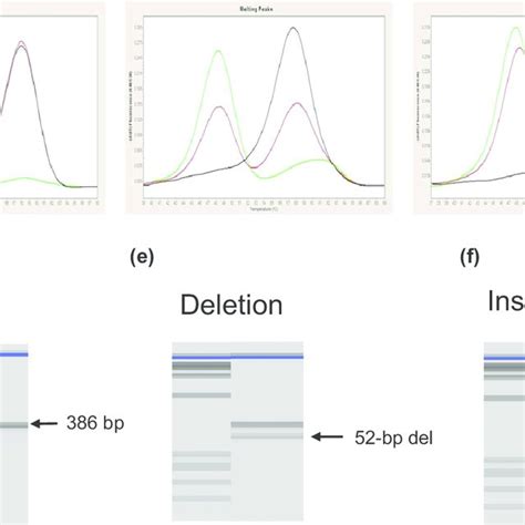 Mutation Analysis Of Jak2 By Melting Curve Analysis And The Calr Gene