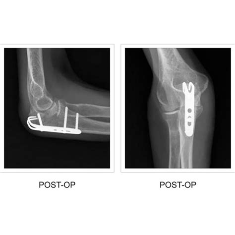 Trimed Olecranon Hook Plate Clinilab