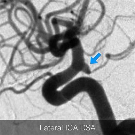 This Is A Pcom Infundibulum And Not An Aneurysm You Can T Flickr