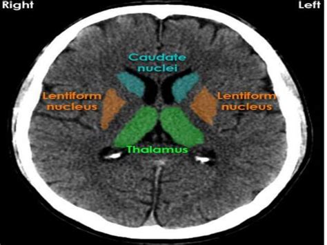 Ct Brain Presentation PPTX