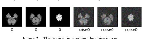 Figure 2 From A New Cnn Based Joint Network For Brain Tumor Denoising And Classification