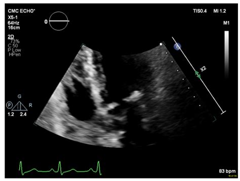 Ampicillin And Daptomycin Combination Therapy For Enterococcus Faecalis Endocarditis After Renal