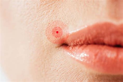 Ptsd And Herpes Simplex Virus In Va Disability Prestige Veteran