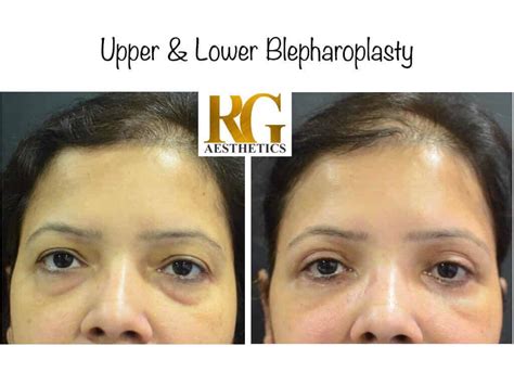 Blepharoplasty Before After Results Dr Rajat Gupta