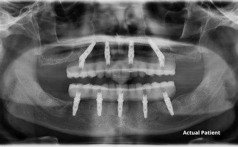Dental Implants Xray