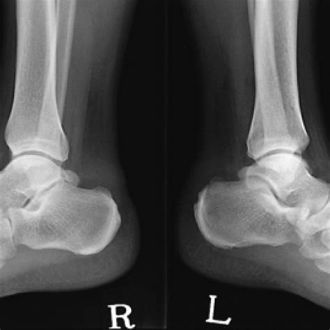 Blurring Of The Cortical Margin Of The Subchondral Bone And Sclerotic