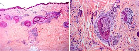 Epithelial Sheath Neuroma Of The Back A Rare Mimicker Of Perineural