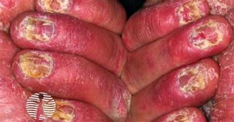 Nail Psoriasis Image
