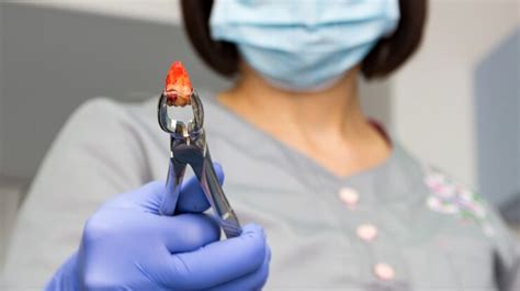 Tooth Extraction And Abscess Myths And Truths