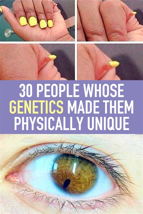 30 People Whose Genetics Made Them Physically Unique Genetics How To