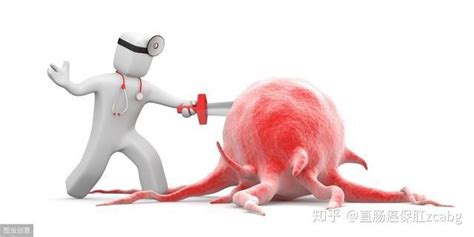 为什么女性多见哨兵痔该如何治疗？ 知乎