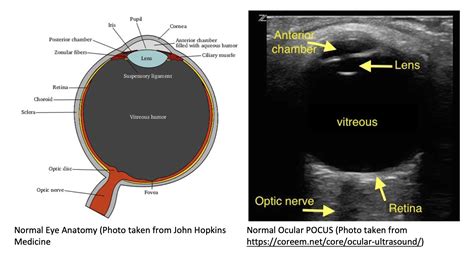 Ocular Pocus Keep Your Prize On The Eyes Emottawa Blog
