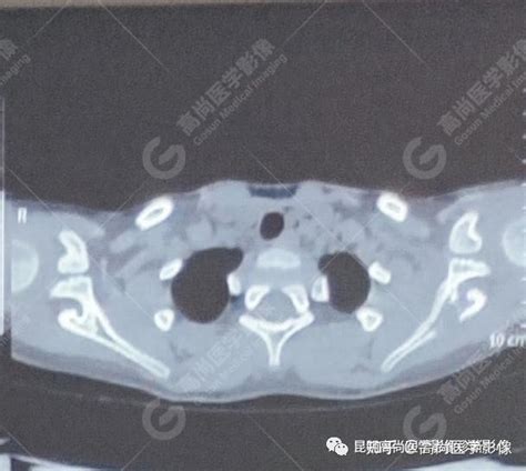 6岁儿童朗格汉斯细胞组织细胞增生症【高尚医学影像】 知乎