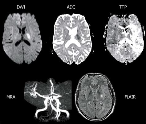 Magnetic Resonance Diffusion Perfusion Mismatch In Acute Ischemic