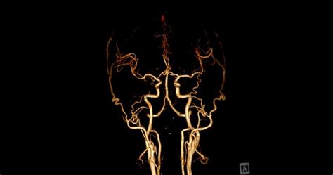 233 Cta Cerebral Artery Royalty Free Photos And Stock Images Shutterstock