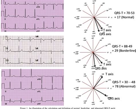 Figure From Prognostic Value Of Frontal Qrs T Angle In Patients Without Clinical Evidence Of