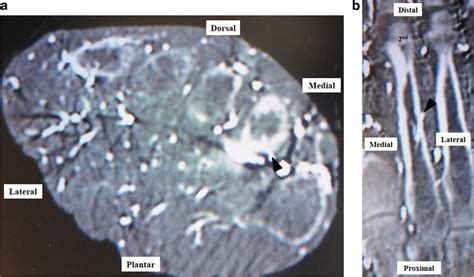 Enhanced Ct Images Showing The Nutrient Artery Entering The Lesser