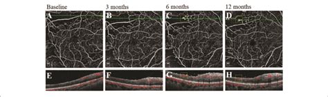 A Typical Severe Nonproliferative Diabetic Retinopathy Npdr Case