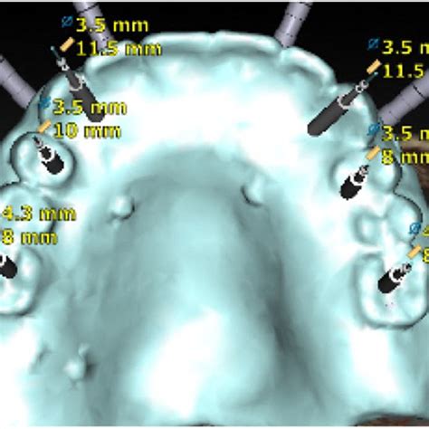 First Digital Scan Of Conversion Prosthesis With Fiducial Markers