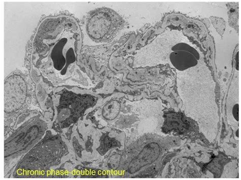 Rapidly Progressive Glomerulonephritis Em