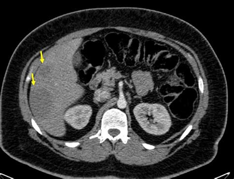Axial Abdomen And Pelvis Ct Scan Showing Hepatic Hypodense Lesion And Download Scientific