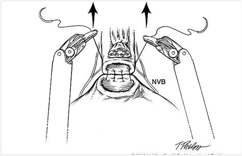 Robotic Nerve Sparing Radical Prostatectomy Uf Health